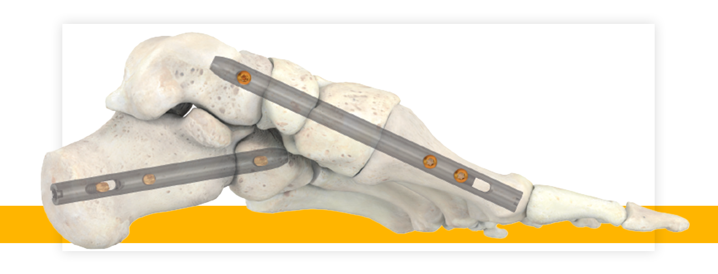 Stryker’s T2 ICF Nail System Offers Surgeons New Option for Patients ...